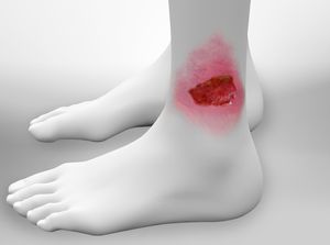Venous Ulcer