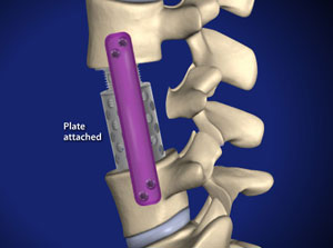 Vertebral Body Replacement (VBR) - Willis Knighton Health - Shreveport ...