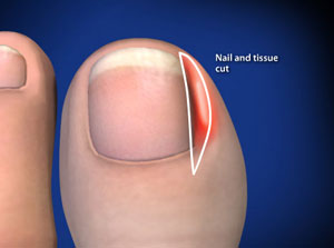 Winograd Procedure for Ingrown Toenail
