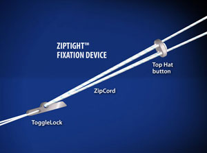 ZipTight Fixation for Ankle Syndesmosis - Willis Knighton Health ...