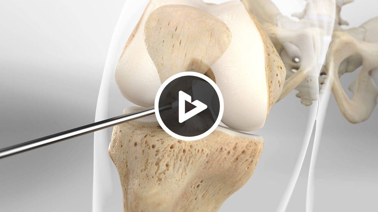 ACL Reconstruction (Hamstring Graft Method) - Foot and Ankle - Willis ...