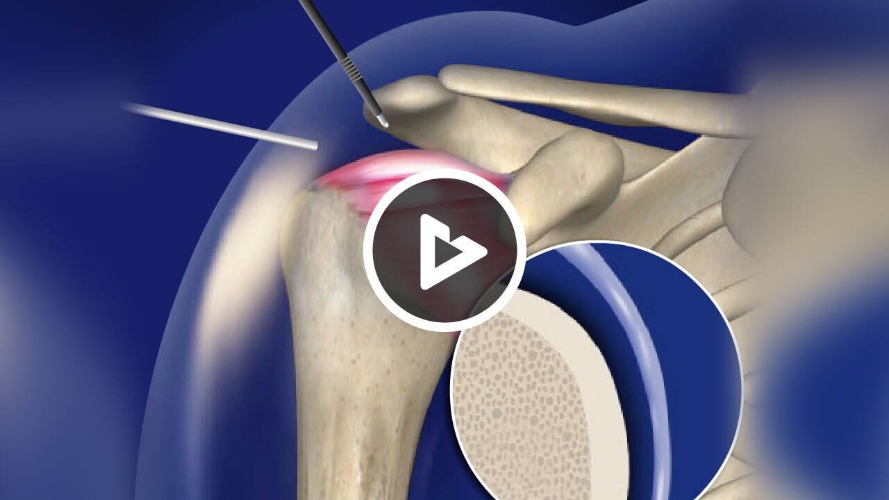 Capsular Release of the Shoulder (Arthroscopic Radiofrequency Method ...