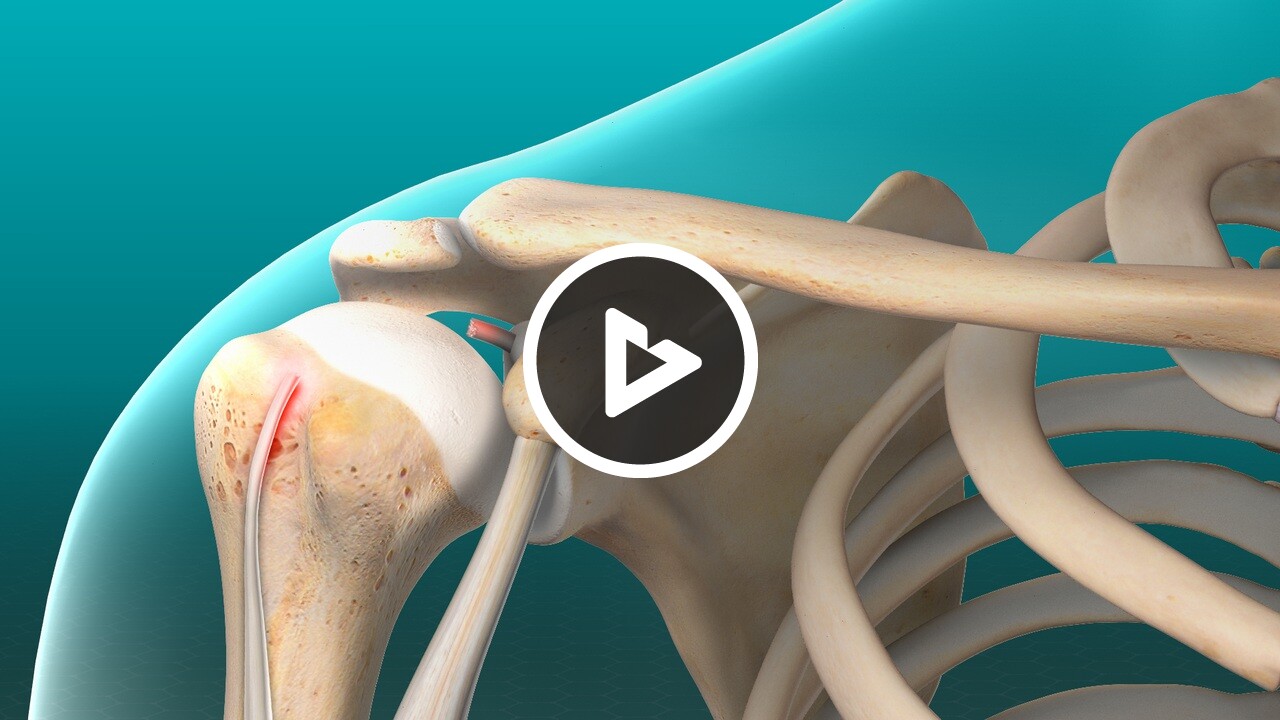 Biceps Tendon Tear (at the Shoulder) - Shoulder and Elbow - Willis ...
