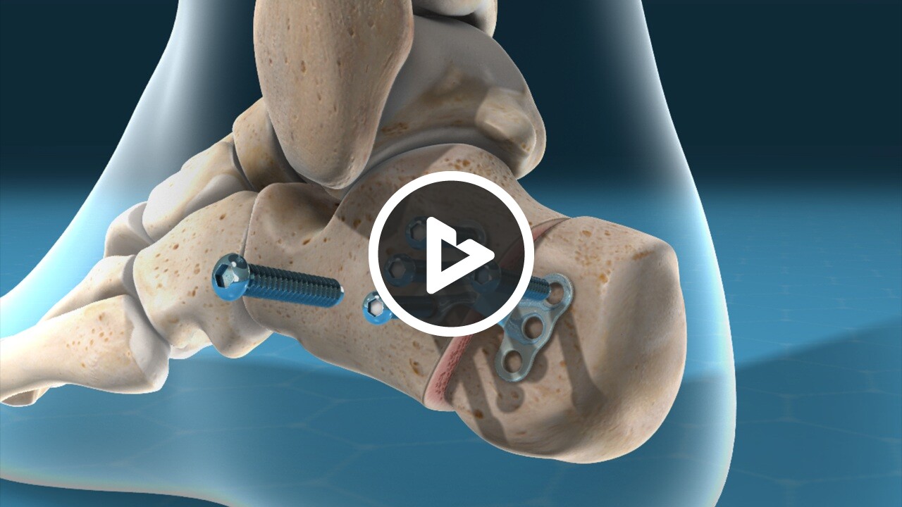 Calcaneal Sliding Osteotomy (with Lateral Plate Fixation) - Medical ...