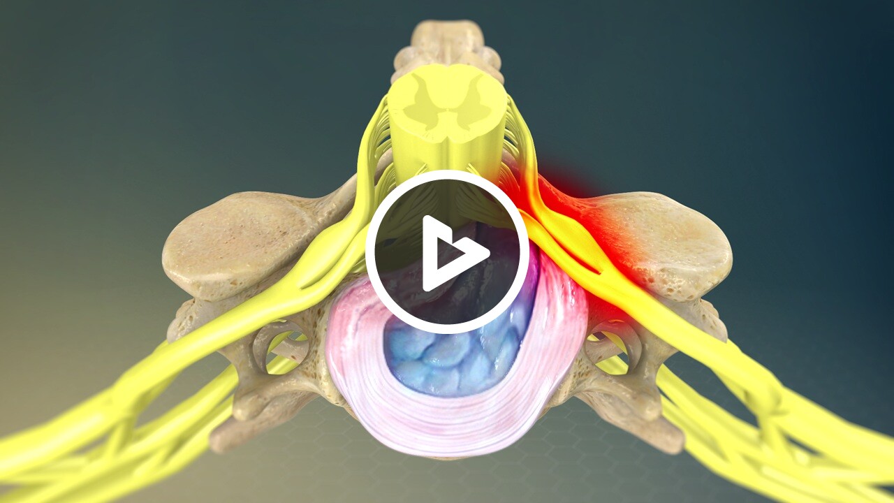 Herniated Disc (Cervical) - Neck and Spine - Willis Knighton Health ...