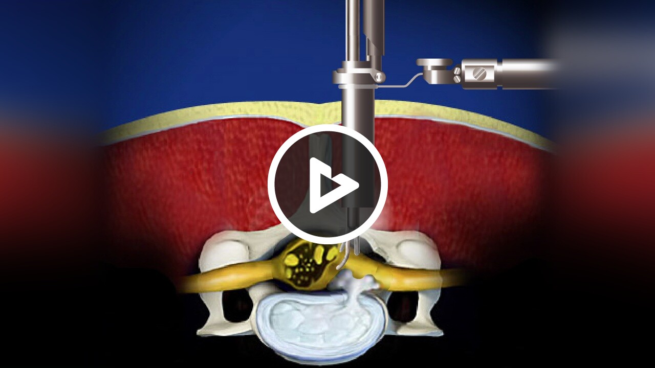 Micro Endoscopic Posterior Cervical Discectomy - Medical Procedures ...