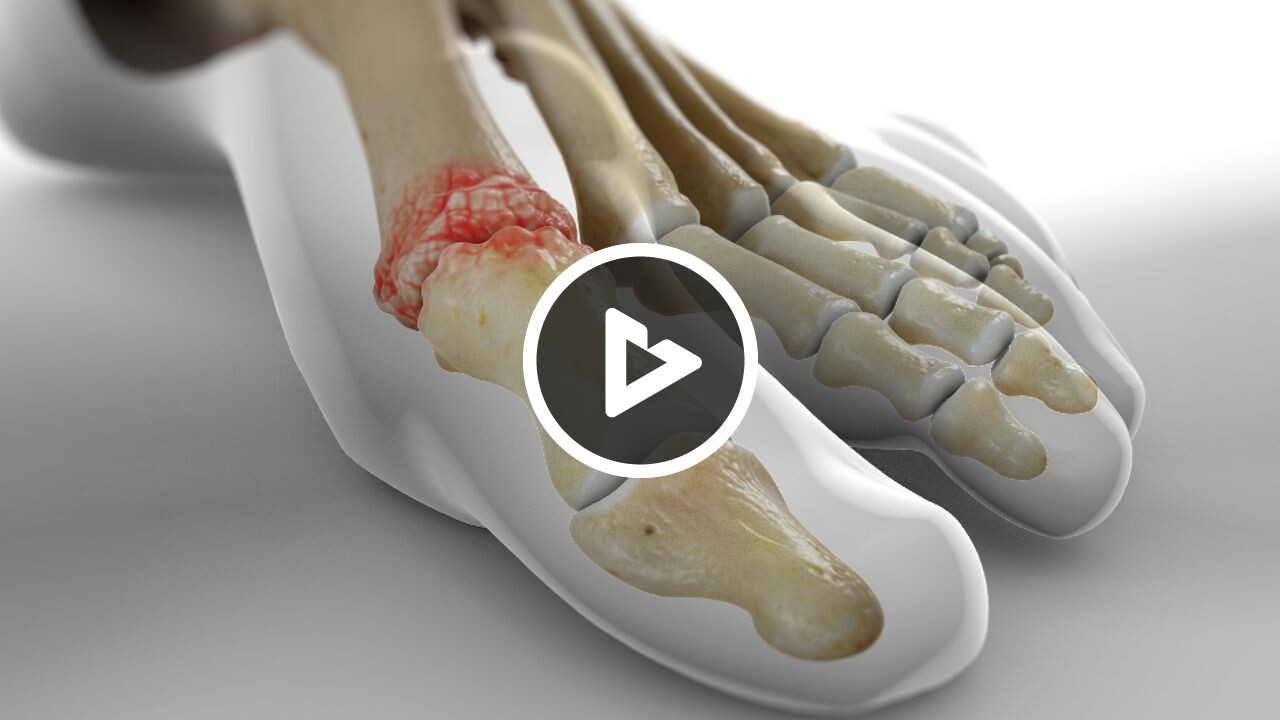 Cheilectomy - Medical Procedures, Tests, Care and Management - Willis ...