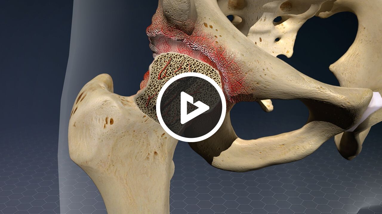 Core Decompression for Avascular Necrosis of the Hip - Medical ...