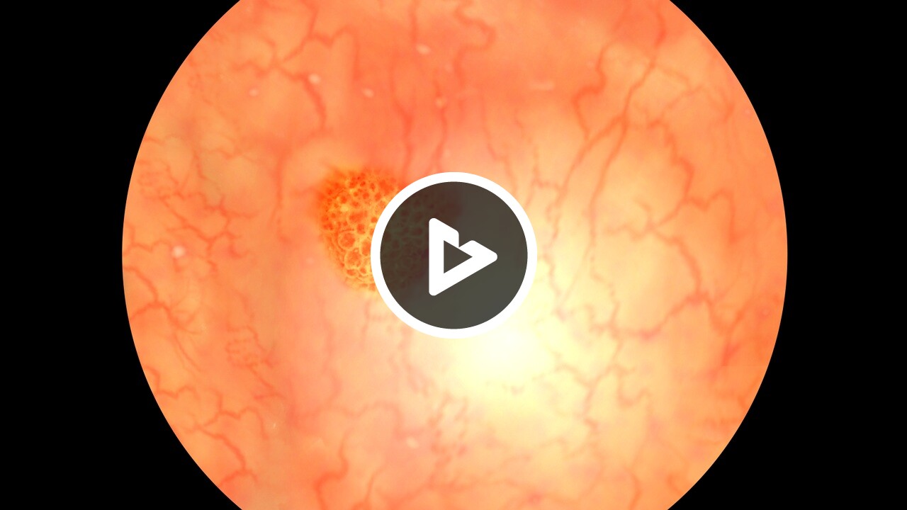 Cystoscopy (Male) - Medical Procedures, Tests, Care and Management ...