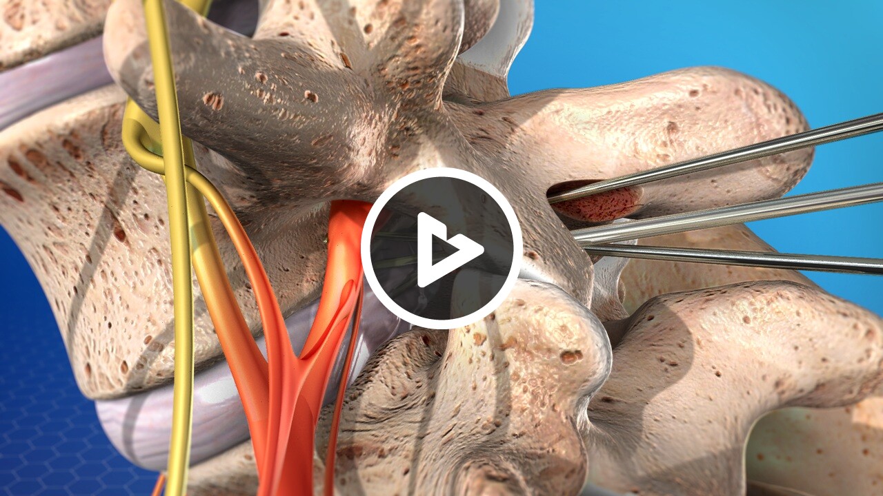 Lumbar Disc Microsurgery - Medical Procedures, Tests, Care and ...