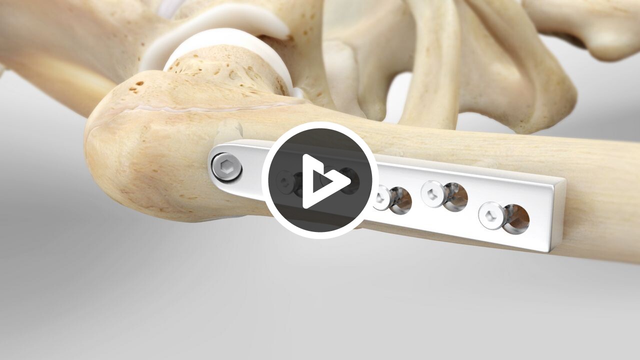 Femur Fracture Fixation (Dynamic Hip Screw Method) - Medical Procedures ...