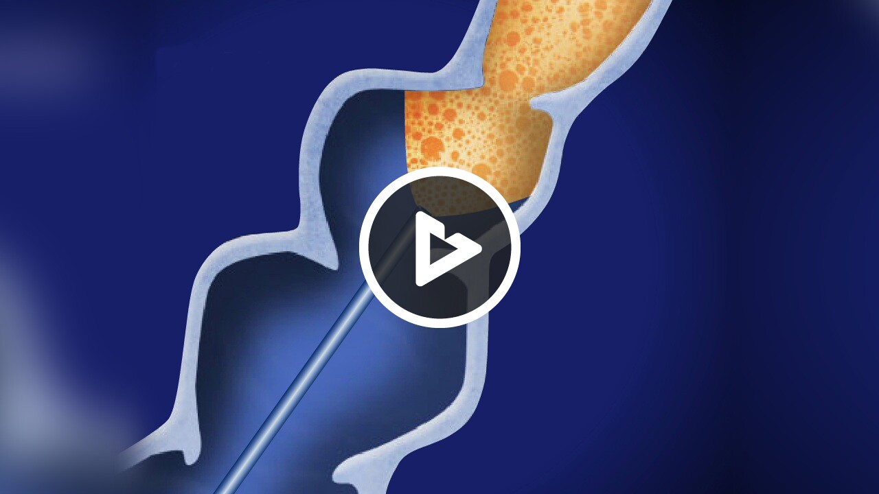 Endovenous Foam Treatment (EVFT) for Varicose Veins - Health Resources ...