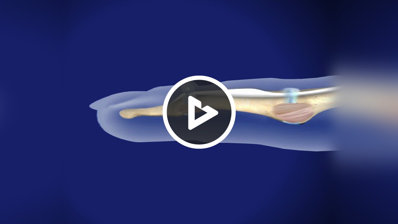 Digital Mucous Cyst Excision - Medical Procedures, Tests, Care and ...