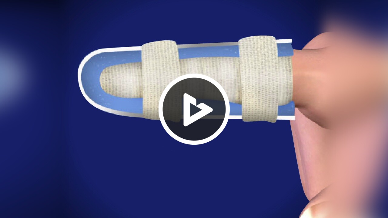 Finger Joint Fusion (DIP Joint) - Medical Procedures, Tests, Care and ...