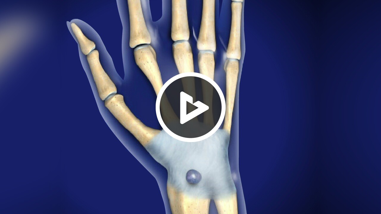 Ganglion Cysts of the Hand - Hand and Wrist - Willis Knighton Health ...