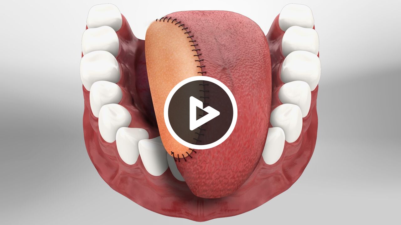 Glossectomy - Medical Procedures, Tests, Care and Management - Willis ...