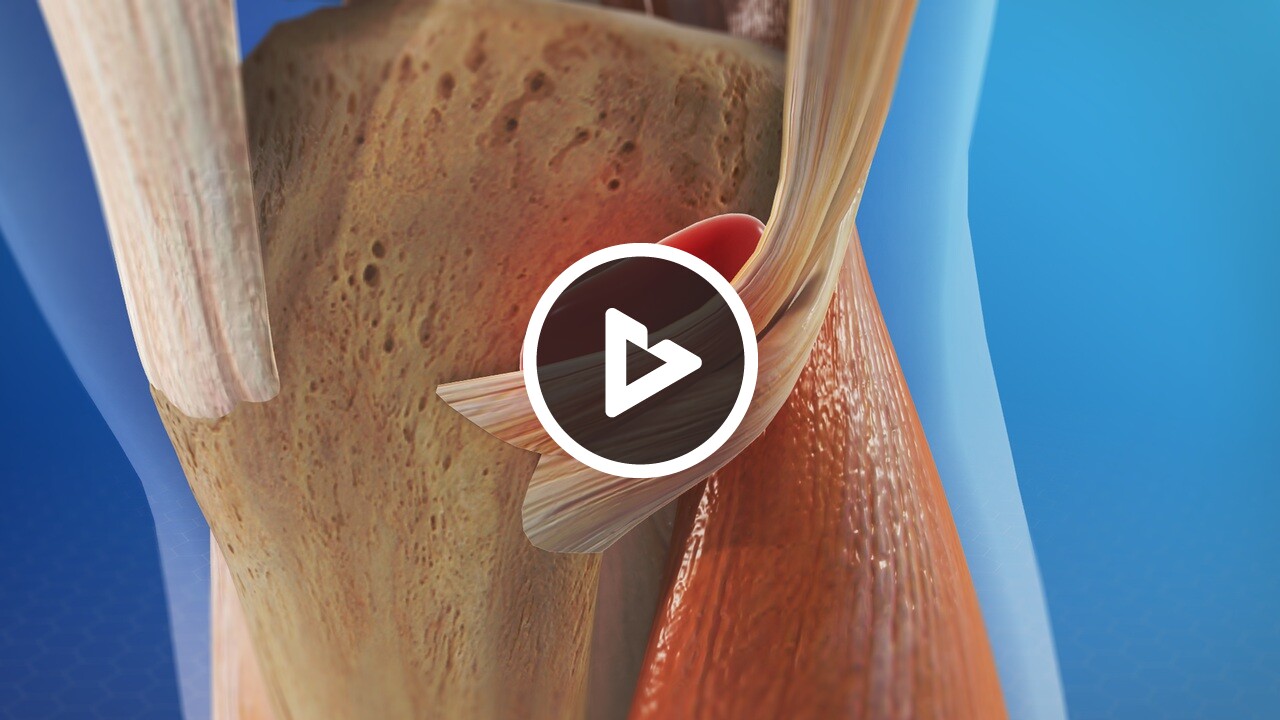 Bursitis of the Knee (Pes Anserine Bursitis) - Disease & Condition ...