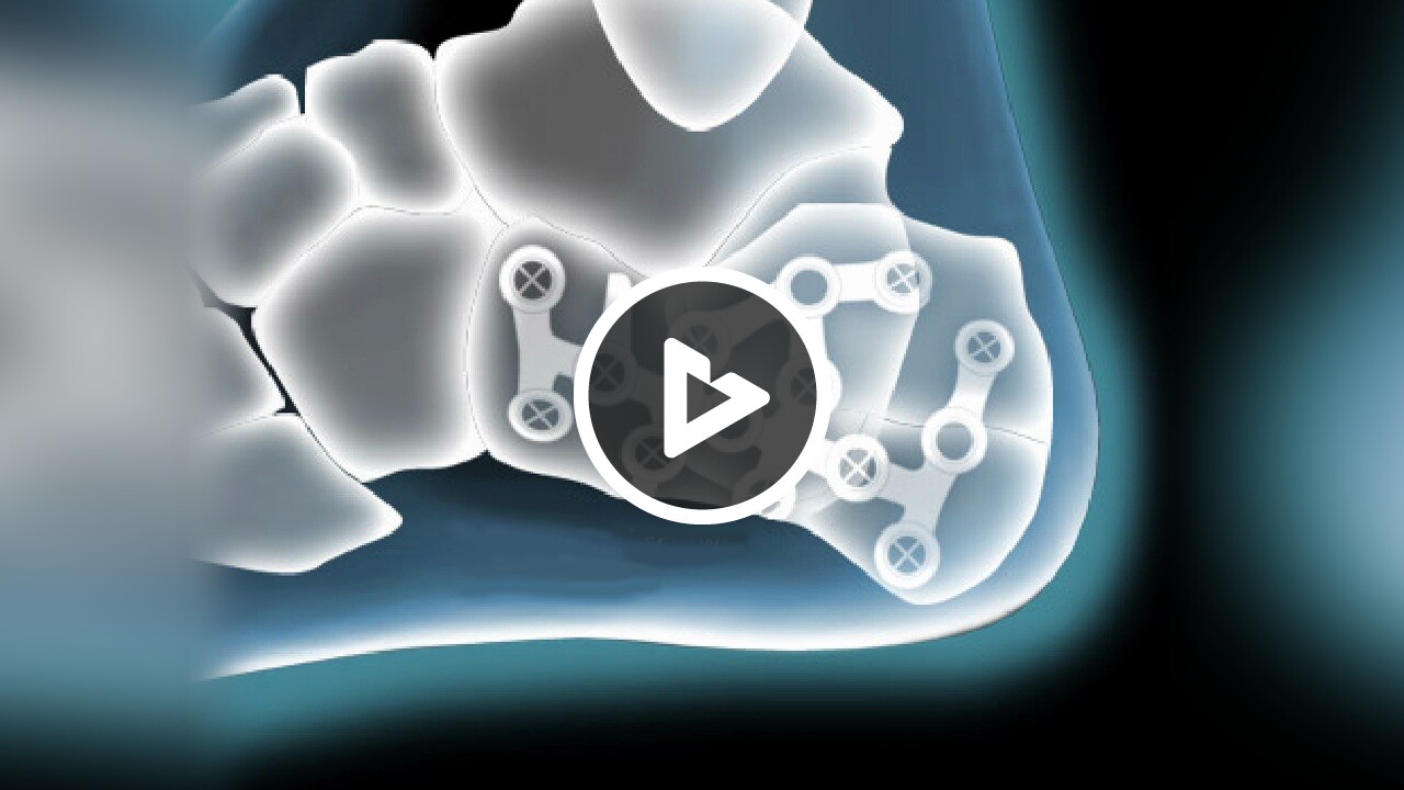 Calcaneal Fracture Fixation (Open Reduction and Internal Fixation ...