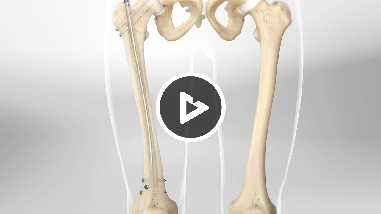 Femur Fracture Fixation with Intramedullary Rod - Medical Procedures ...
