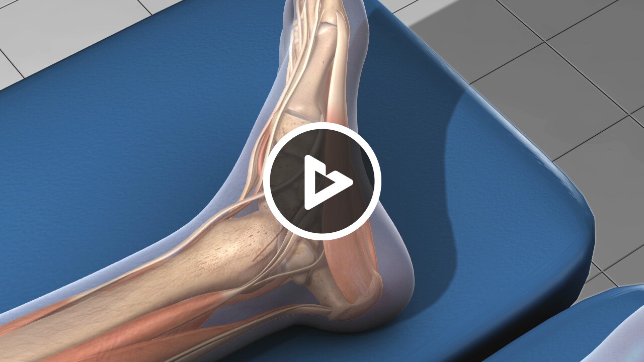 Kidner Procedure - Medical Procedures, Tests, Care and Management ...