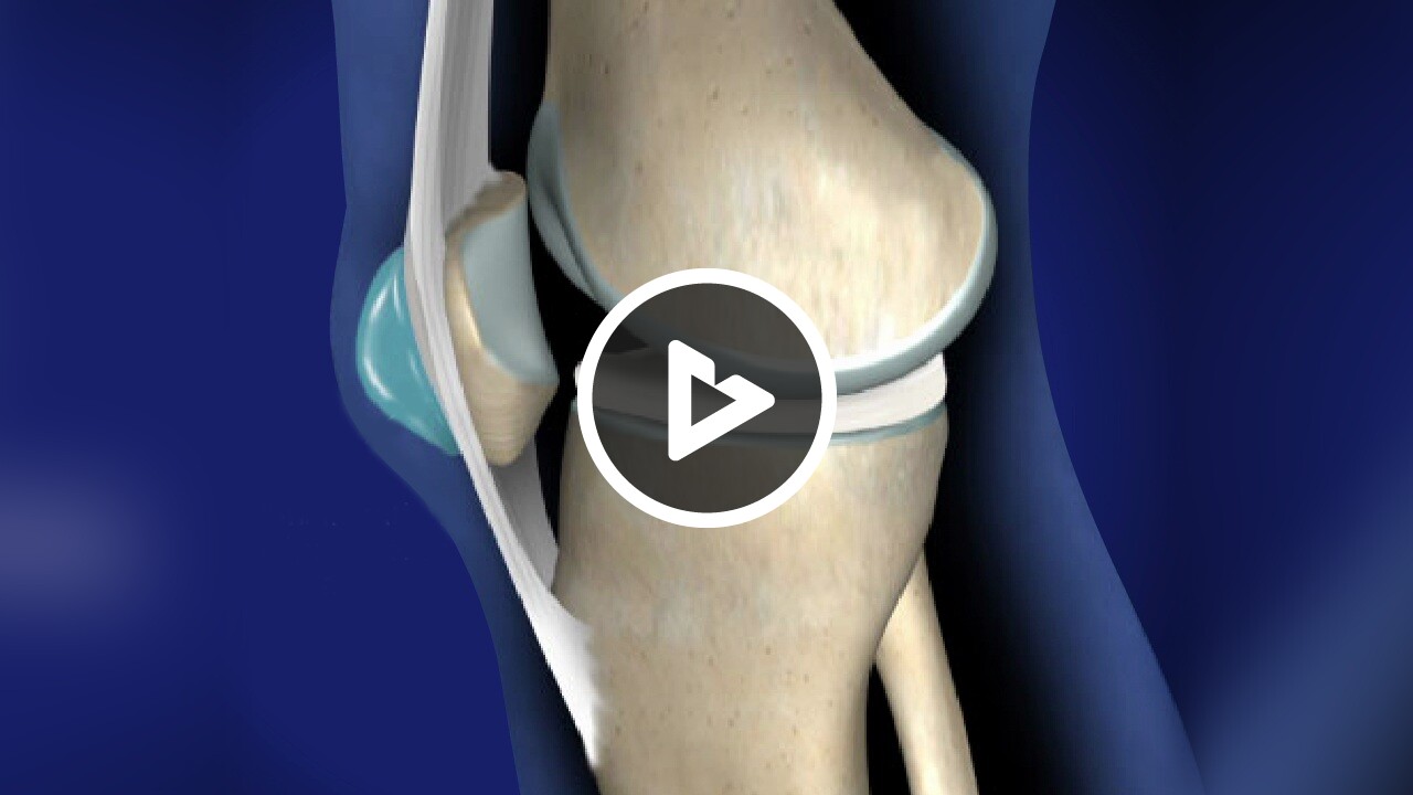 Prepatellar Bursitis (Kneecap Bursitis) - Knees - Willis Knighton ...