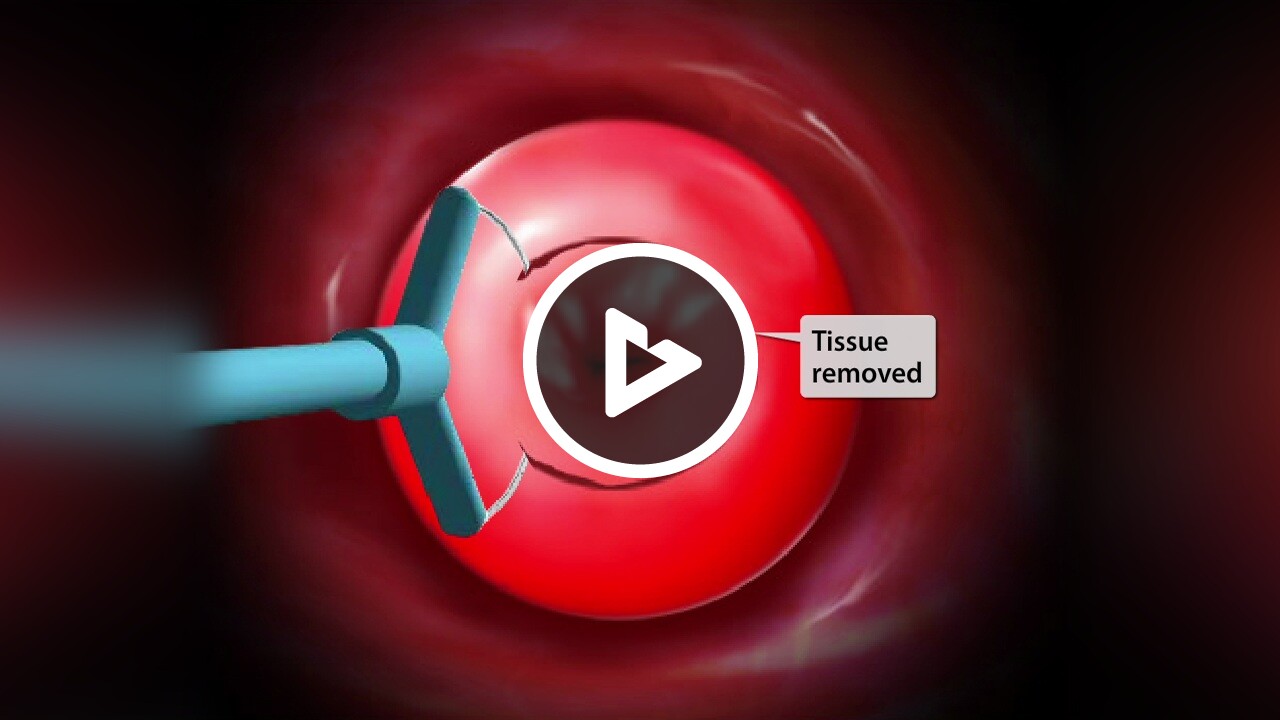 LEEP (Loop Electrosurgical Excision Procedure) - Medical Procedures ...