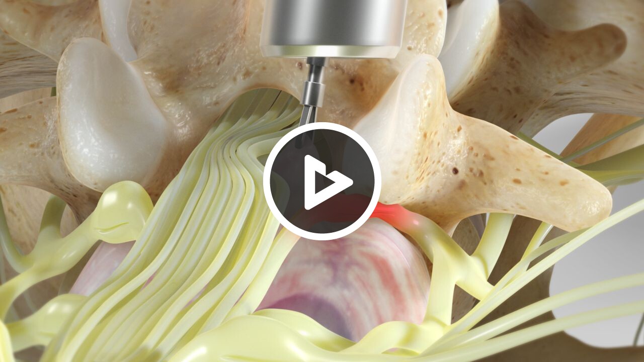 Micro Endoscopic Discectomy (in the Lumbar Spine) - Medical Procedures ...