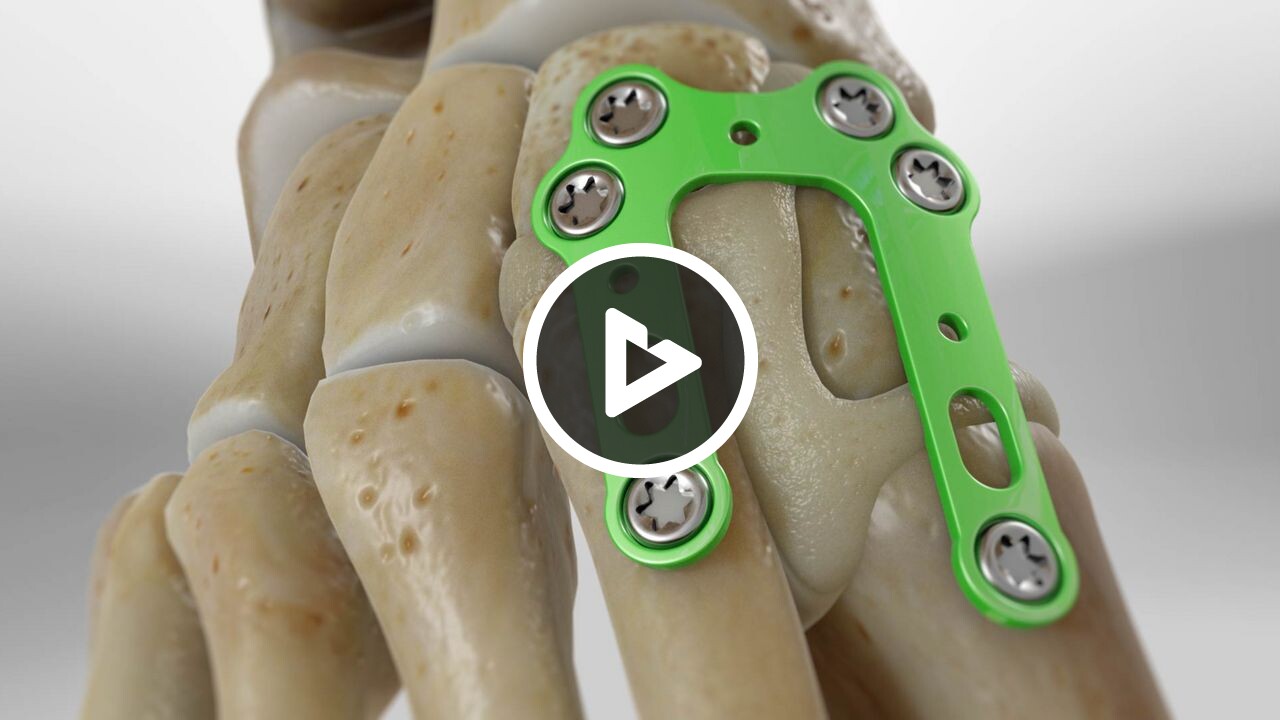 Midfoot Fusion - Medical Procedures, Tests, Care and Management ...