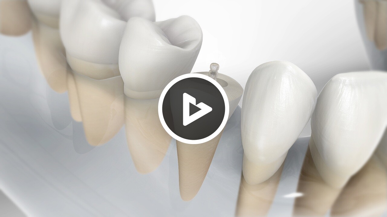 Post and Core Restoration (Prefabricated Post System) - Medical ...