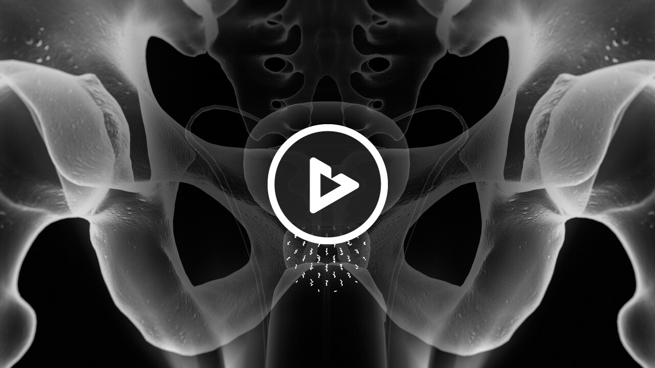 Prostate Seed Implantation (Permanent Low Dose Rate Brachytherapy ...