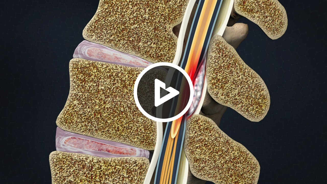 Spinal Epidural Abscess - Neck and Spine - Willis Knighton Health - Top ...