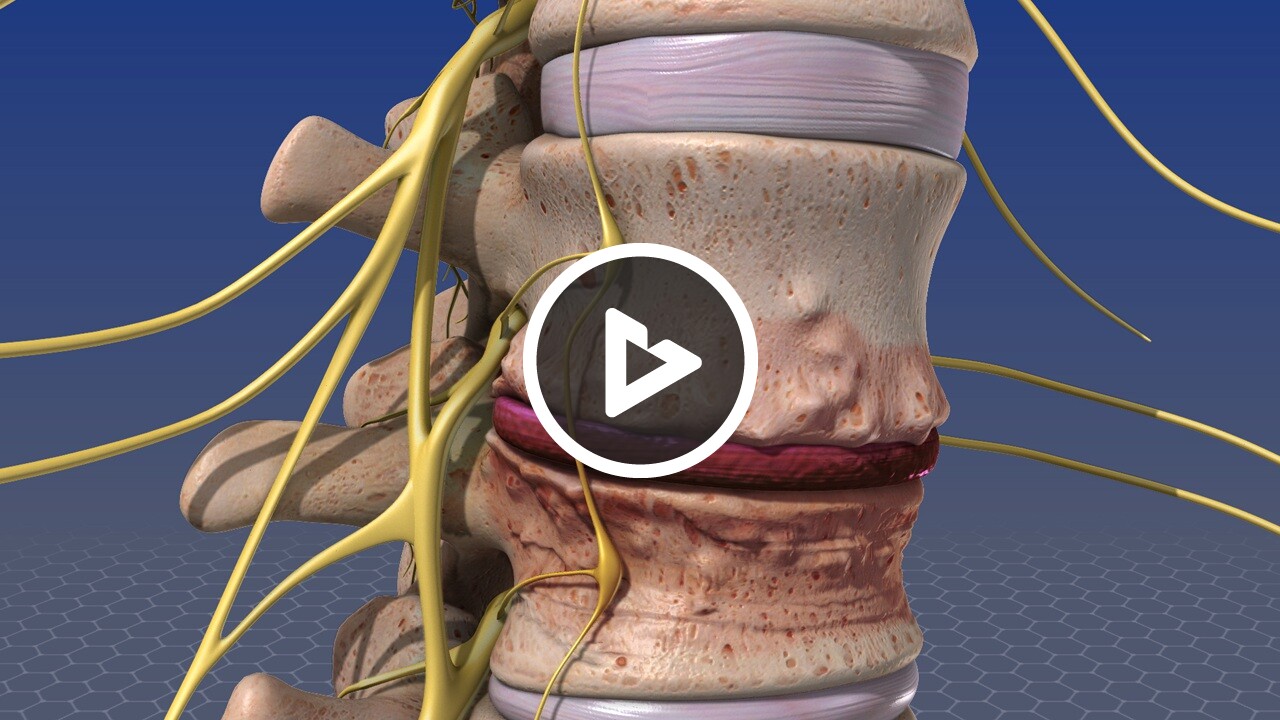 Spinal Infection - Neck and Spine - Willis Knighton Health - Top ...