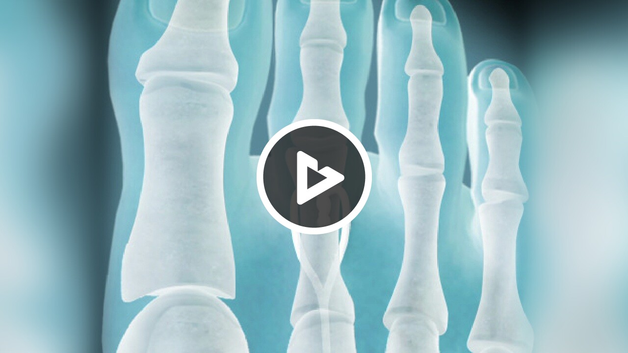 Tendon Transfer for Hammertoe (FDL tendon transfer) - Medical ...
