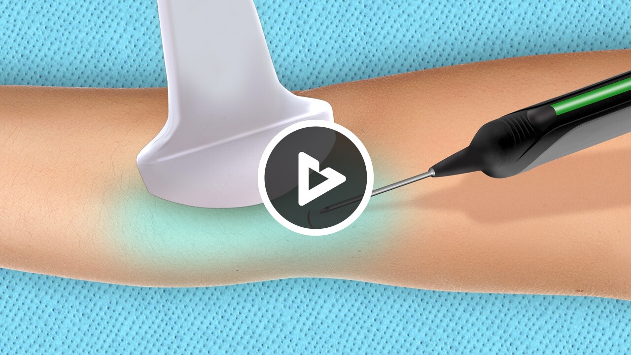 Ultrasonic Tendon Scar Tissue Removal (Percutaneous Method) - Medical ...