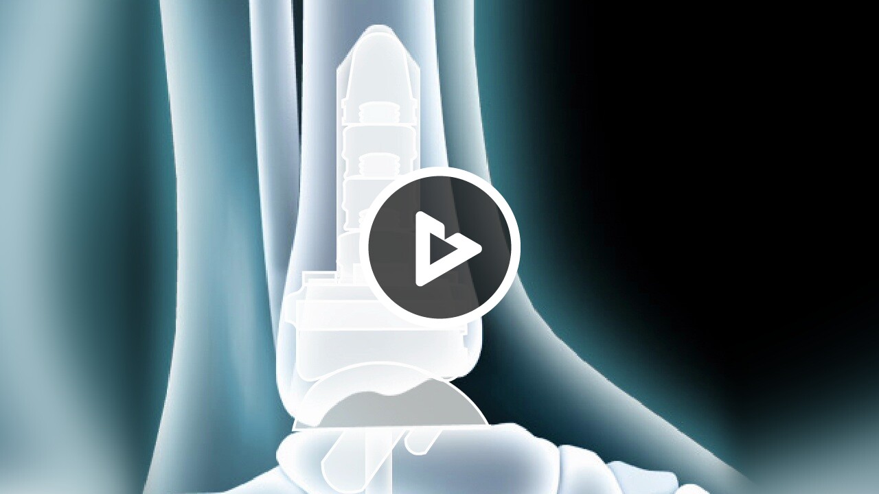 Total Ankle Joint Replacement (Wright INBONE II) - Medical Procedures ...