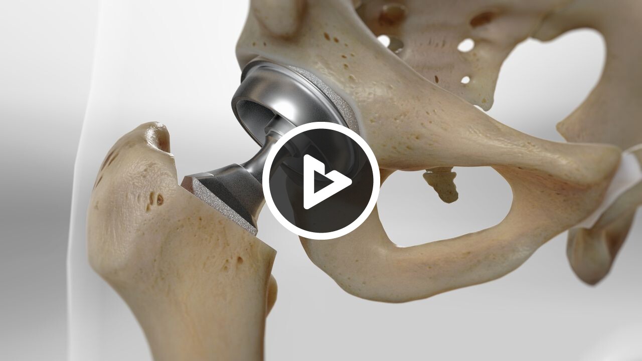 Total Hip Replacement (Minimally-Invasive Method, Large-Diameter ...
