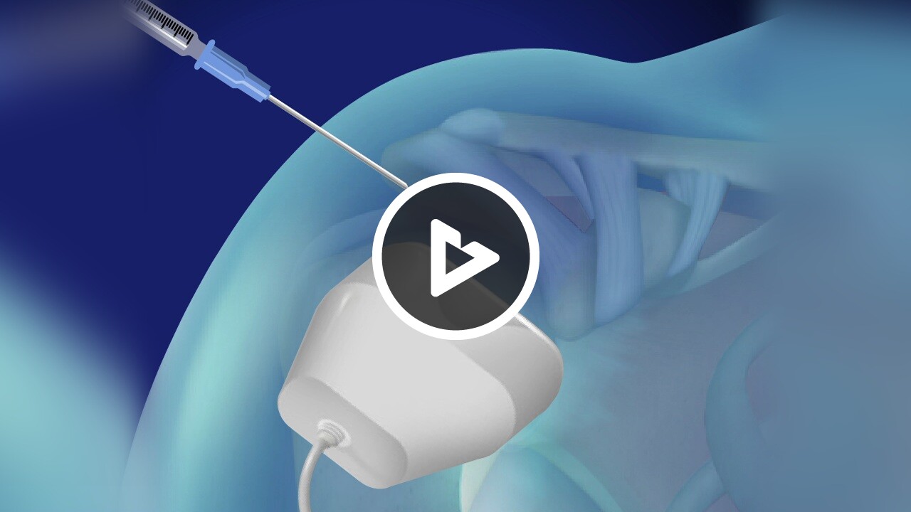 Ultrasound-Guided Injection for Shoulder Pain - Shoulder and Elbow ...